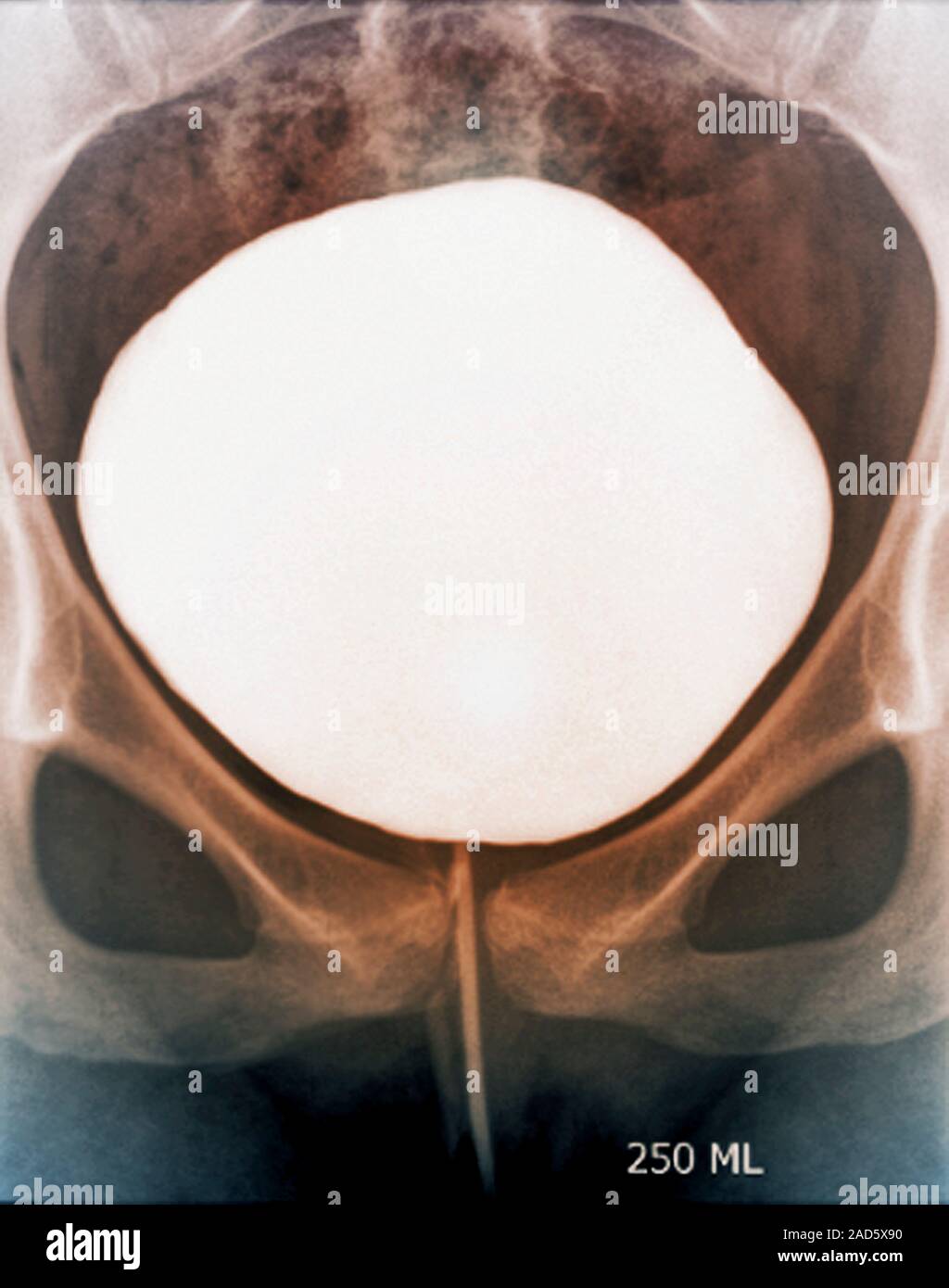 Urinary bladder examination. Coloured retrograde and urinary ...