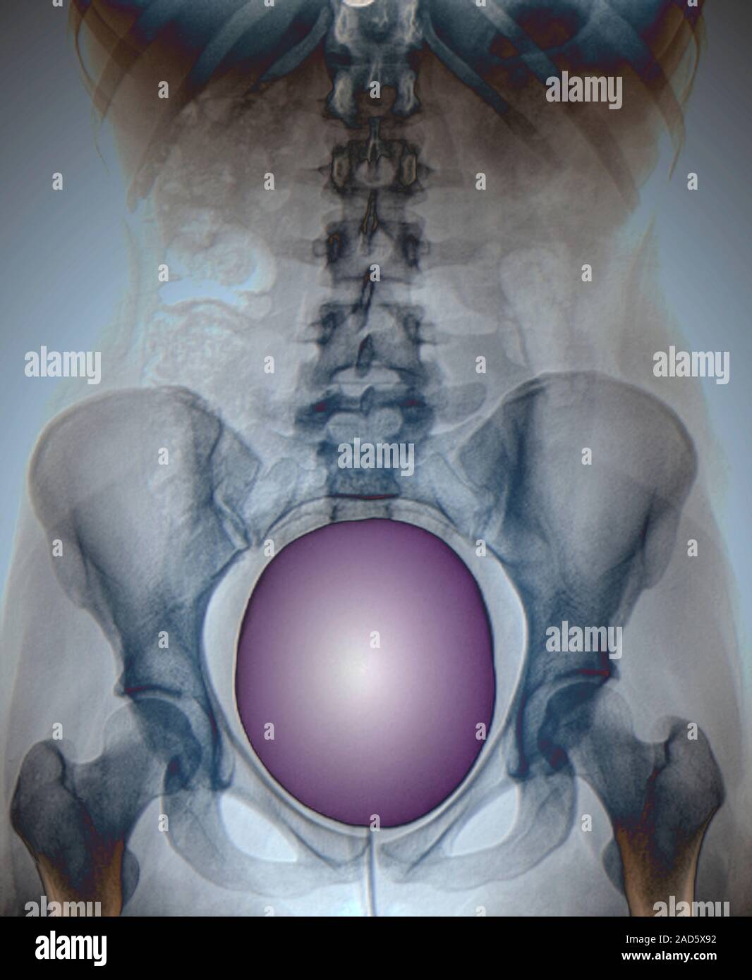 Urinary bladder examination. Coloured retrograde and urinary ...