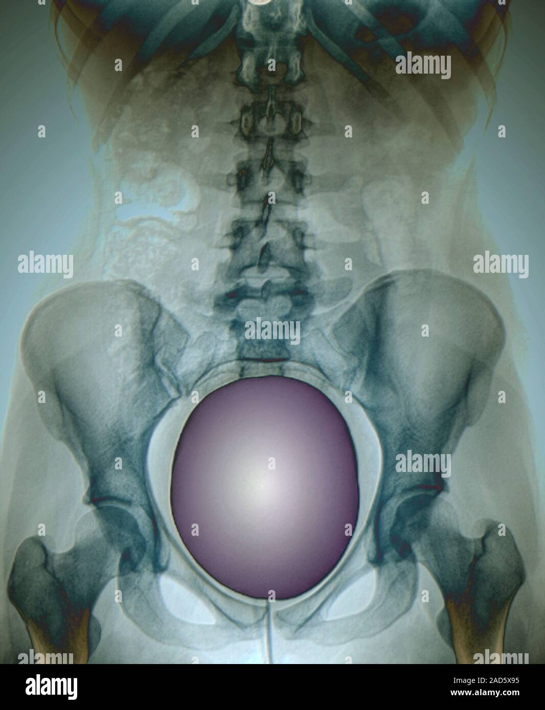 Urinary bladder examination. Coloured retrograde and urinary ...