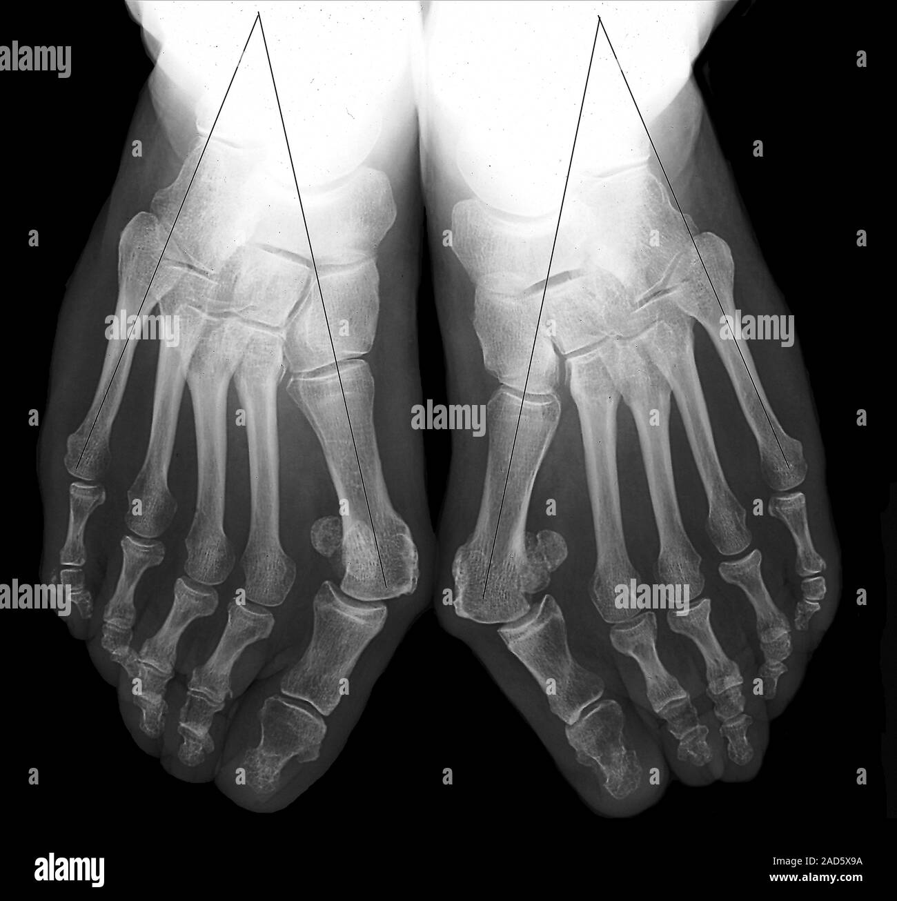 Bunion assessment. X-rays showing a 70-year-old woman's feet with ...