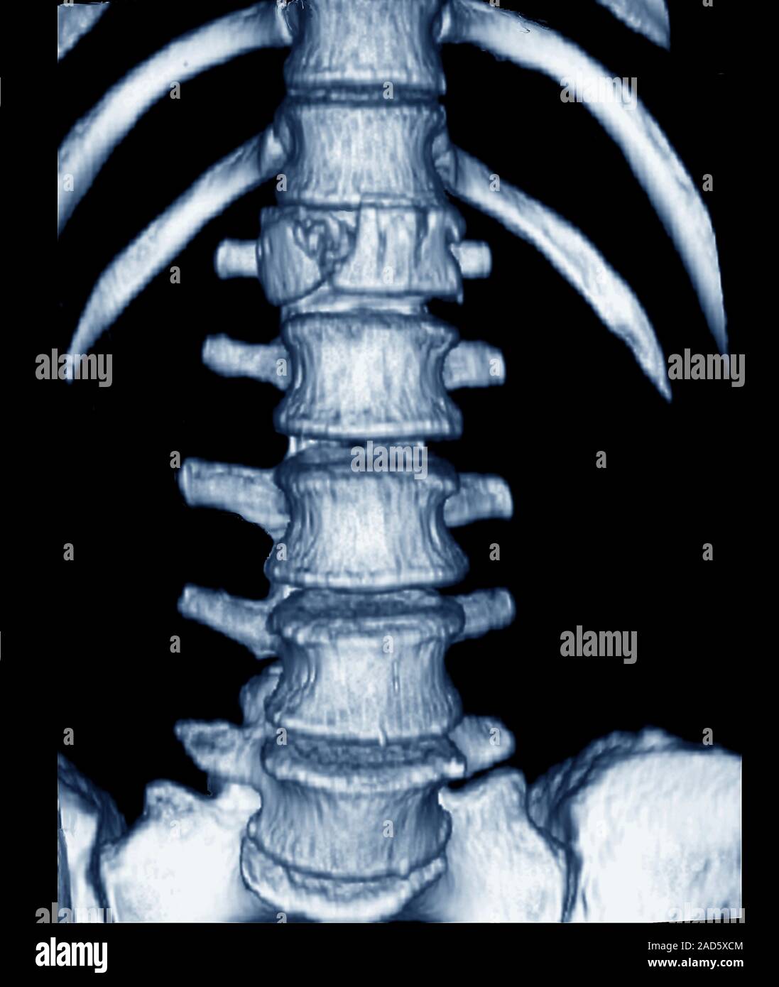 Fractured Vertebra Coloured 3d Computed Tomography Ct Scan Image Of