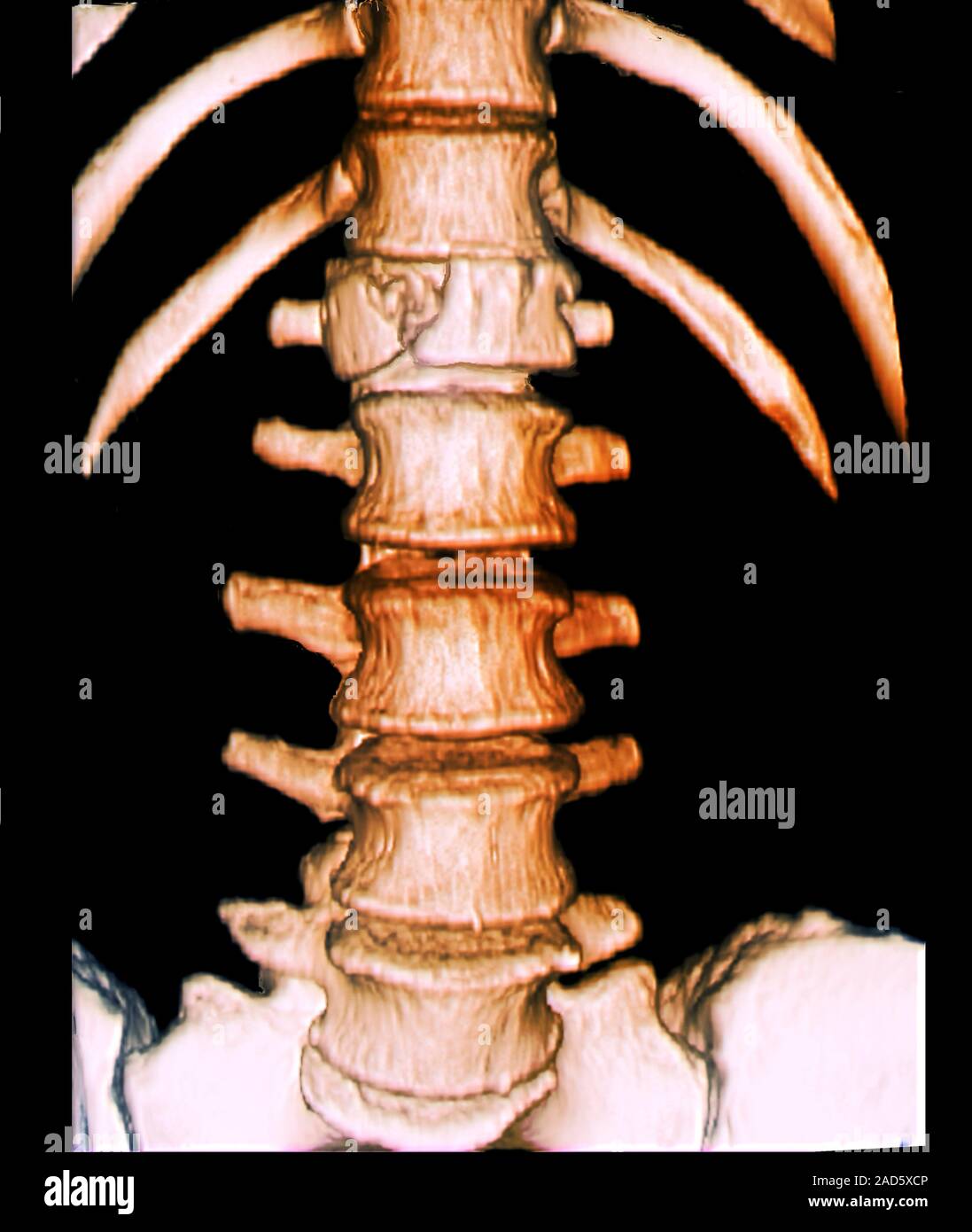 Fractured Vertebra Coloured 3d Computed Tomography Ct Scan Image Of