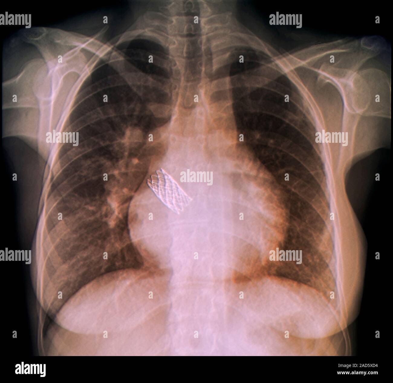 Congenital heart defects. Coloured X-ray of the chest of a 23-year-old ...