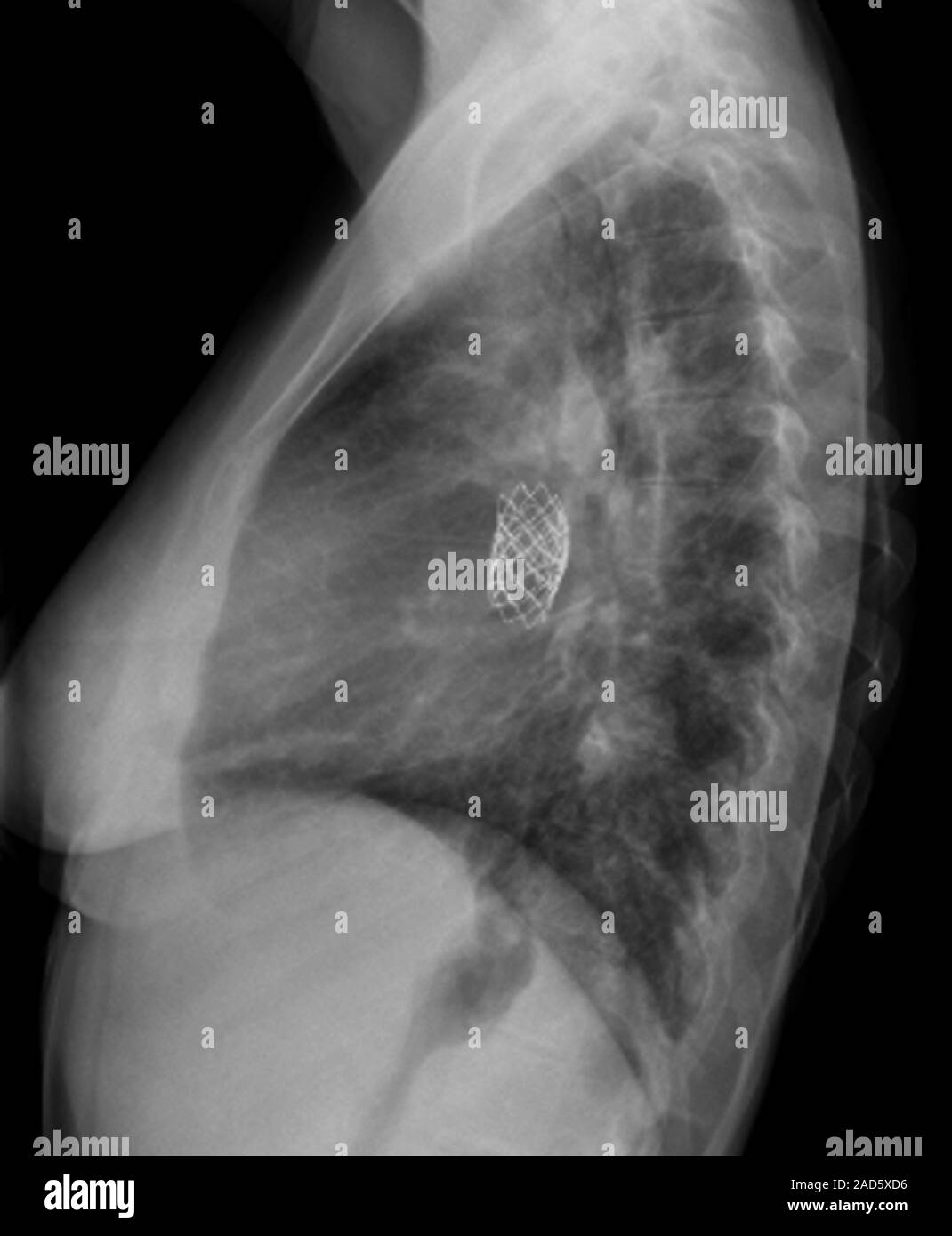 Congenital heart defects. Lateral X-ray of the chest of a 23-year-old ...