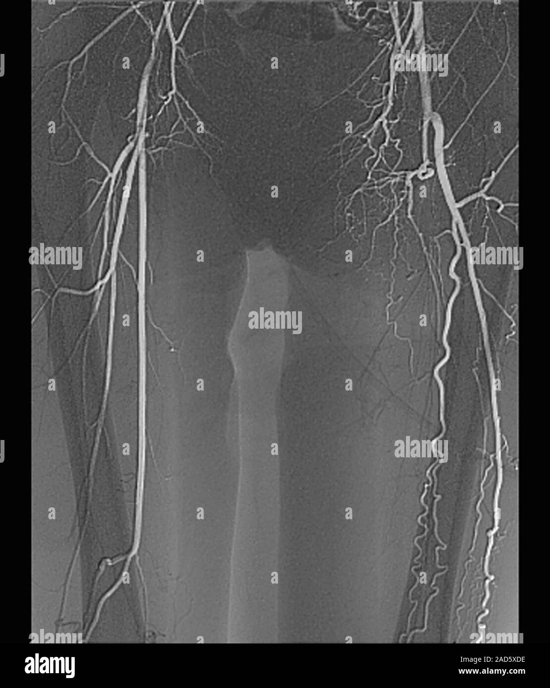 Blocked femoral artery. Angiogram (blood vessel X-ray) of the legs of a ...