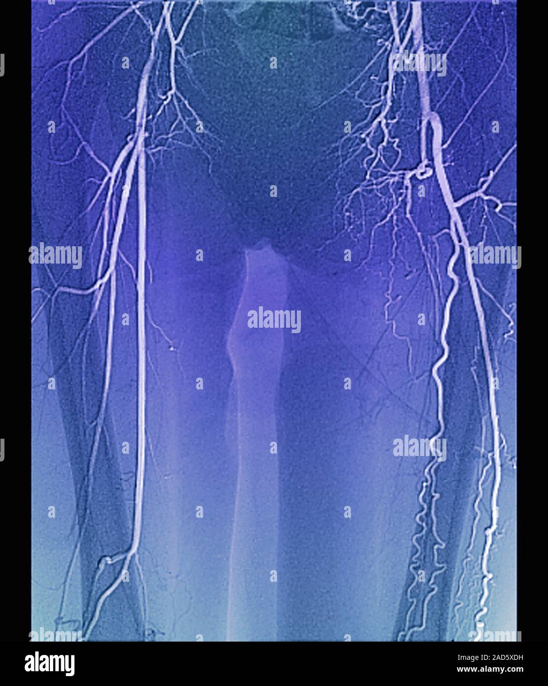 Blocked femoral artery. Coloured angiogram (blood vessel X-ray) of the legs of a 26-year-old ...