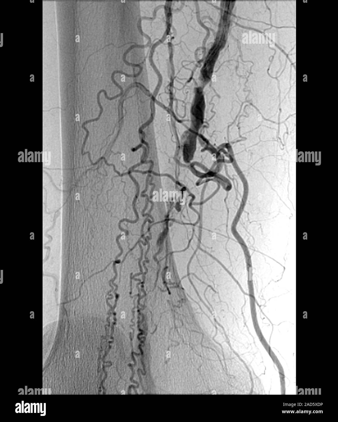 Blocked femoral artery. Angiogram (blood vessel X-ray) of part of the right leg of a 77-year-old ...