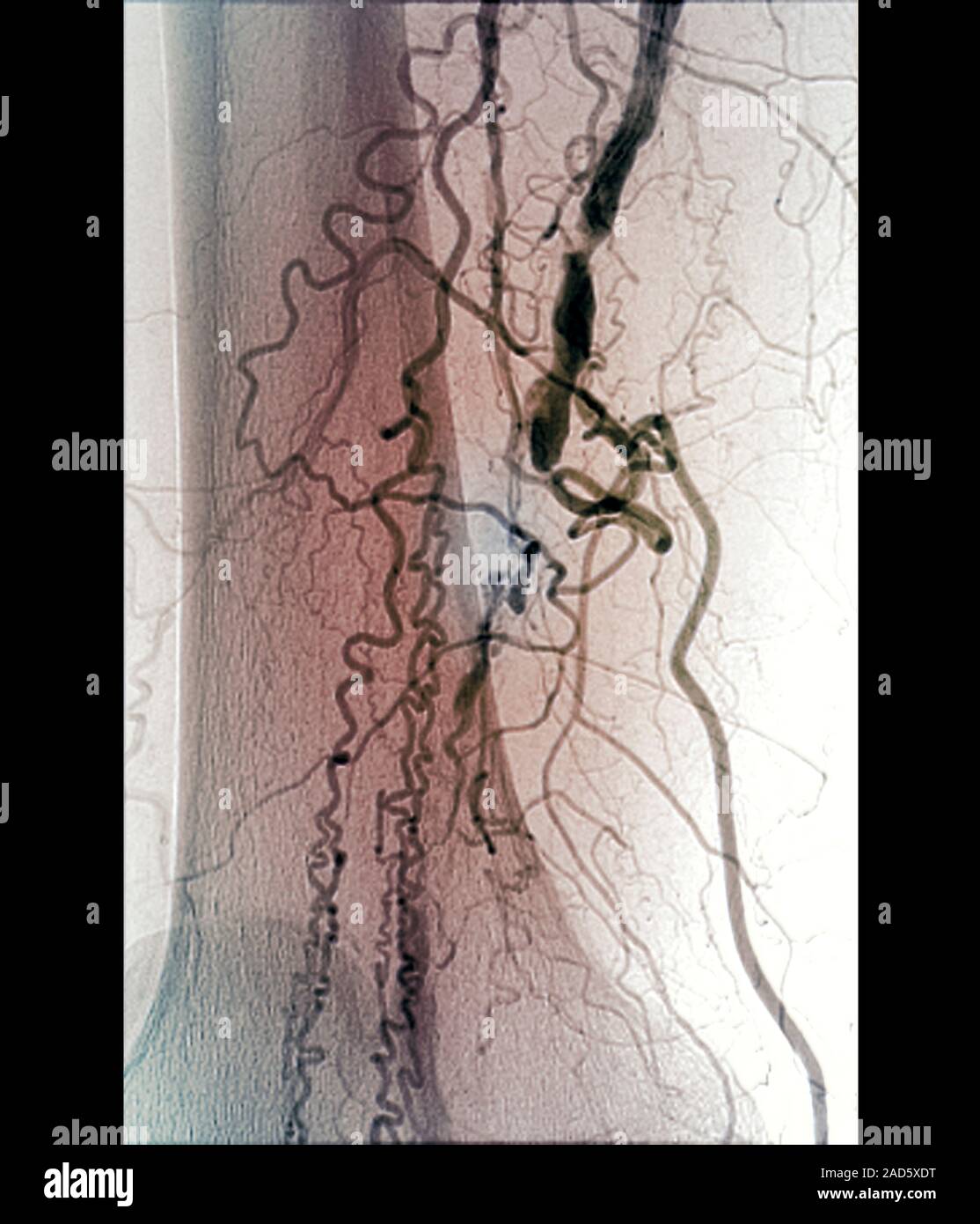 Blocked femoral artery. Coloured angiogram (blood vessel X-ray) of part of the right leg of a 77 ...