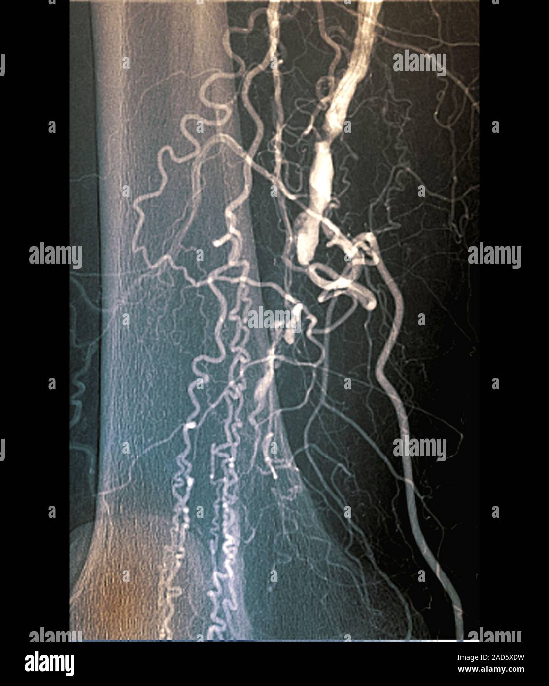 Blocked femoral artery. Coloured angiogram (blood vessel X-ray) of part ...