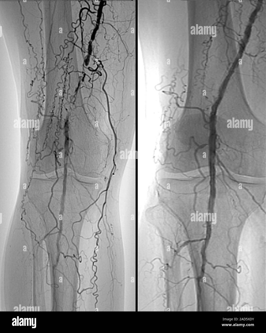 Treatment for blocked femoral artery. Angiograms (blood vessel X-rays ...