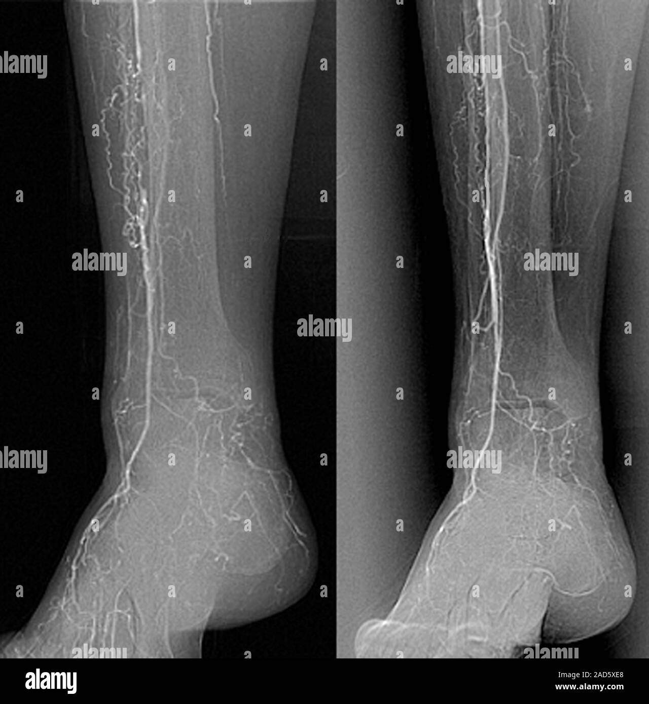 Treatment for blocked leg arteries. Angiograms (blood vessel X-rays) of the right lower legs of ...