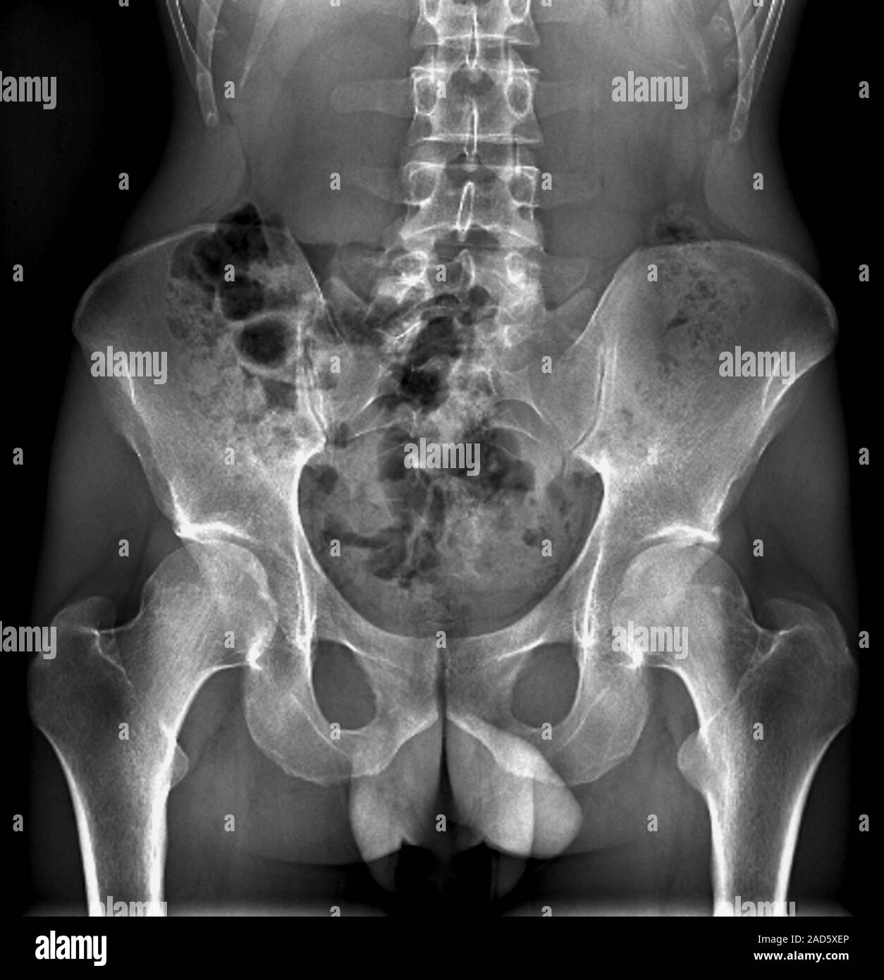 Male pelvis bones and joints. Frontal X-ray of the bones and joints of ...