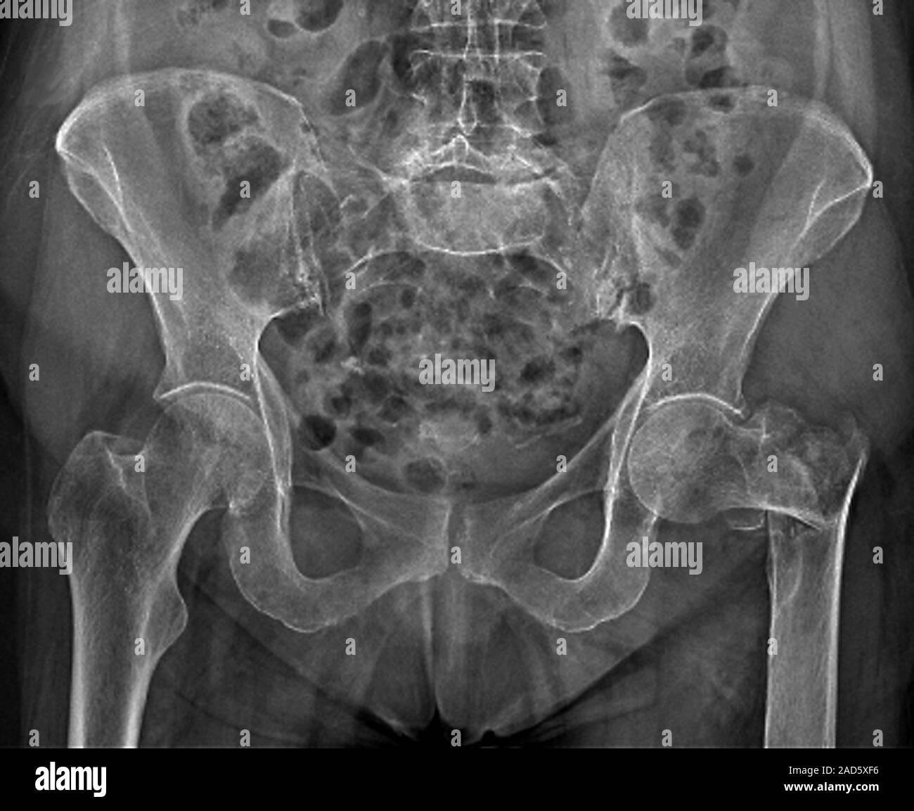 Fractured hip joint. Frontal X-ray of a fracture (lower right) of the ...