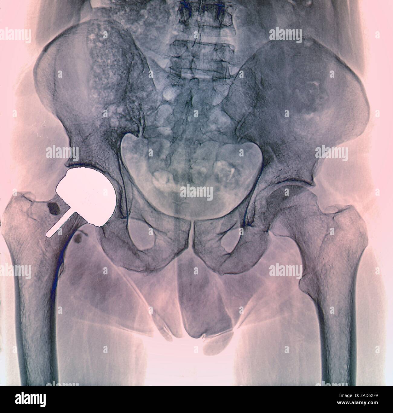 Hip joint resurfacing. Coloured frontal X-ray of the pelvis of a 52 ...
