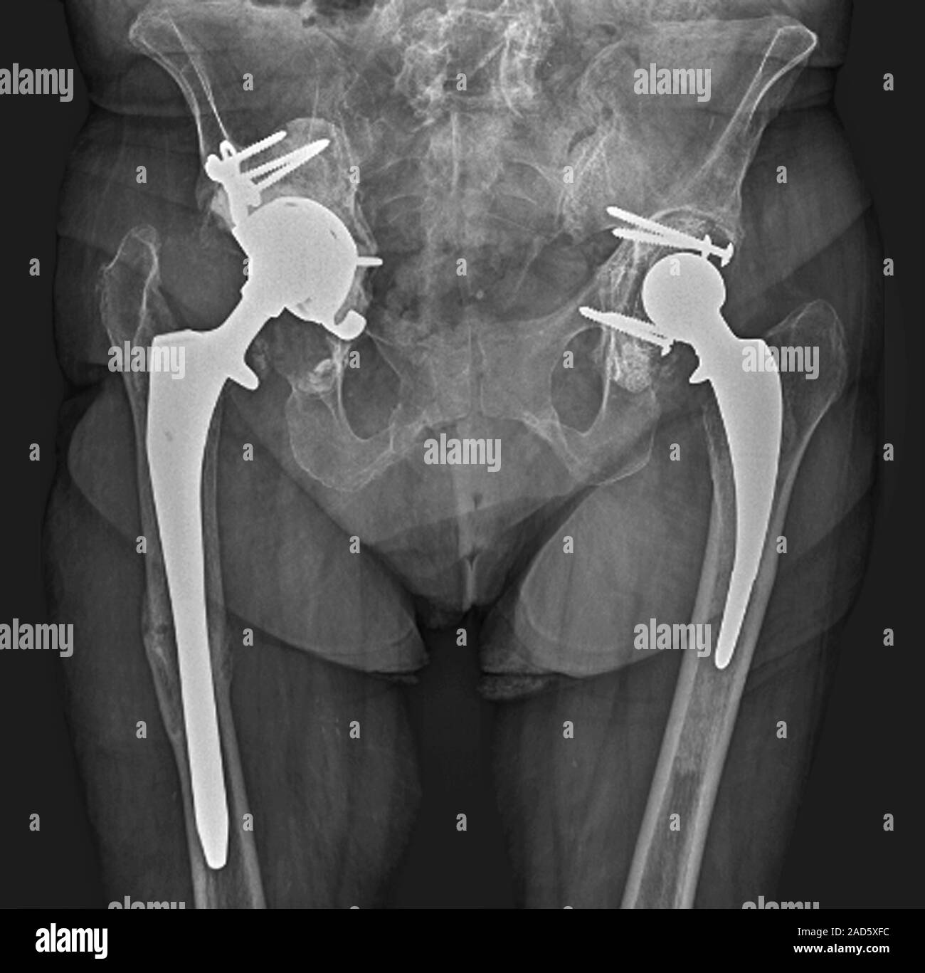 Double hip replacement. Frontal X-ray of the pelvis of an 87-year-old woman who has had a double ...