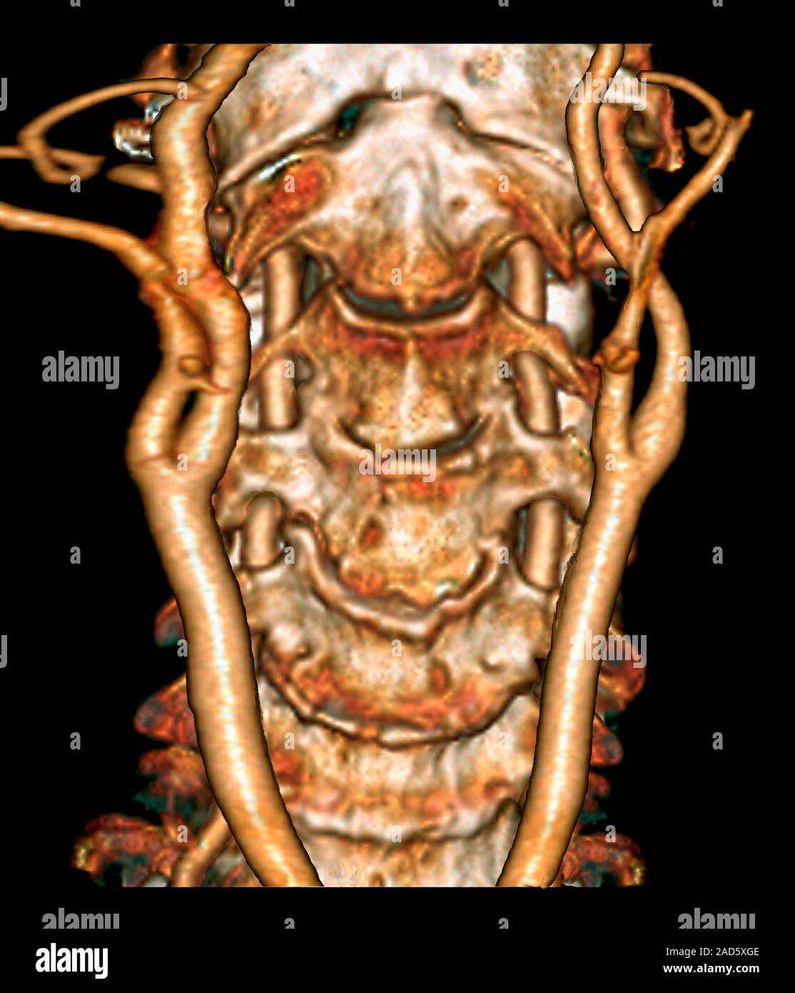 Cervical spine and arteries. Coloured 3D computed tomography (CT) scan and angiogram, showing a ...