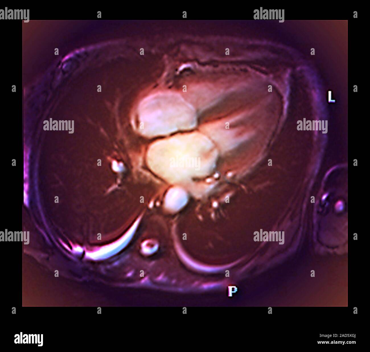 Cardiac mitral valve leak. Coloured magnetic resonance imaging (MRI ...