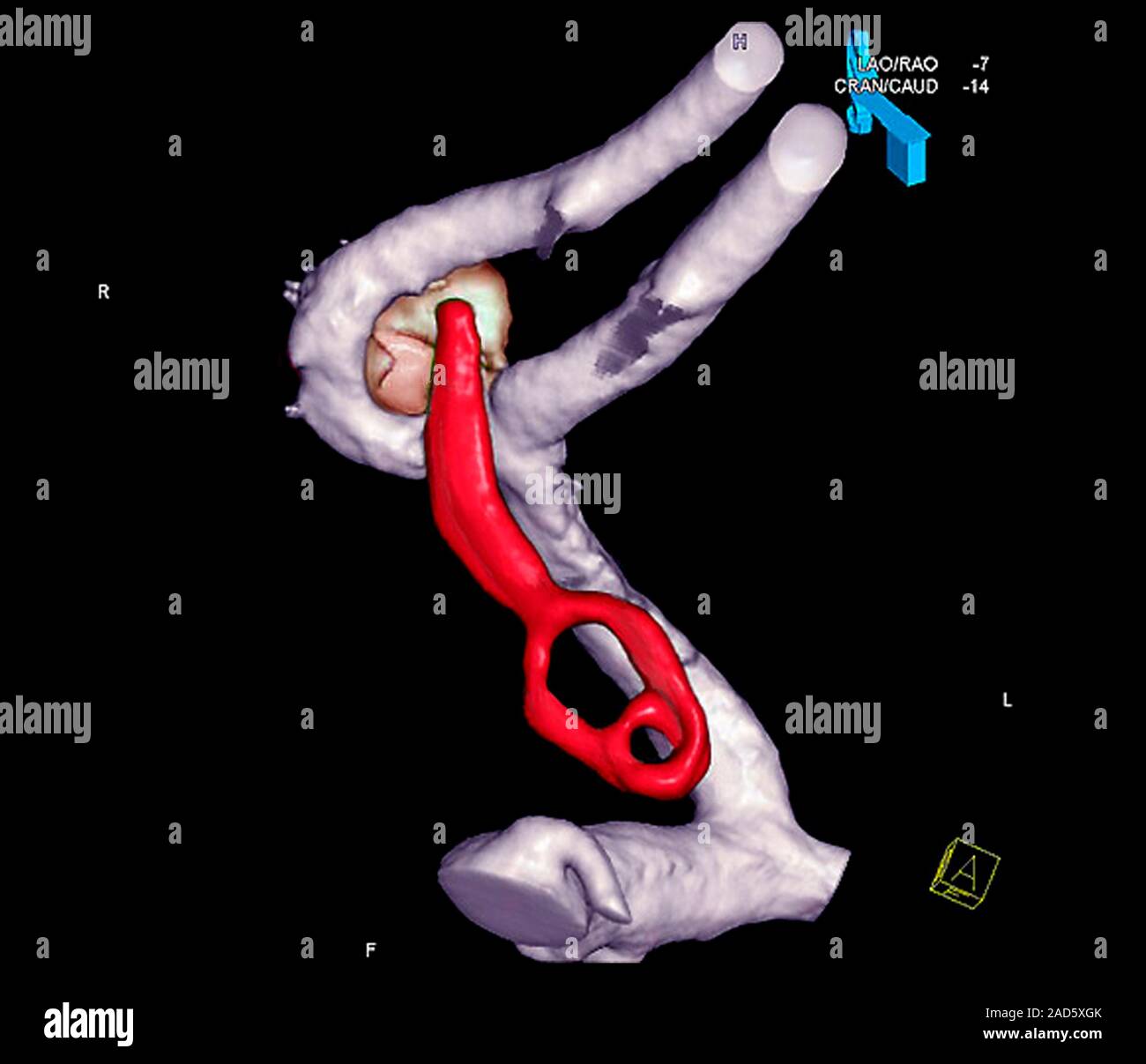 Brain aneurysm treatment. Coloured 3D computed tomography (CT) scan and angiogram, showing part ...