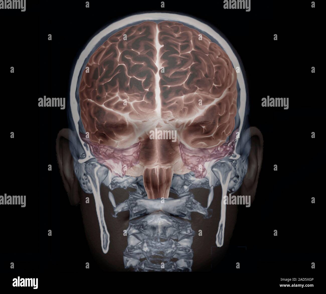 Brain and skull anatomy. Coloured 3D computed tomography (CT) scan of ...