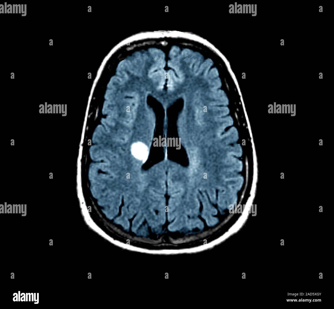 Multiple sclerosis. Axial magnetic resonance imaging (MRI) scan of the ...