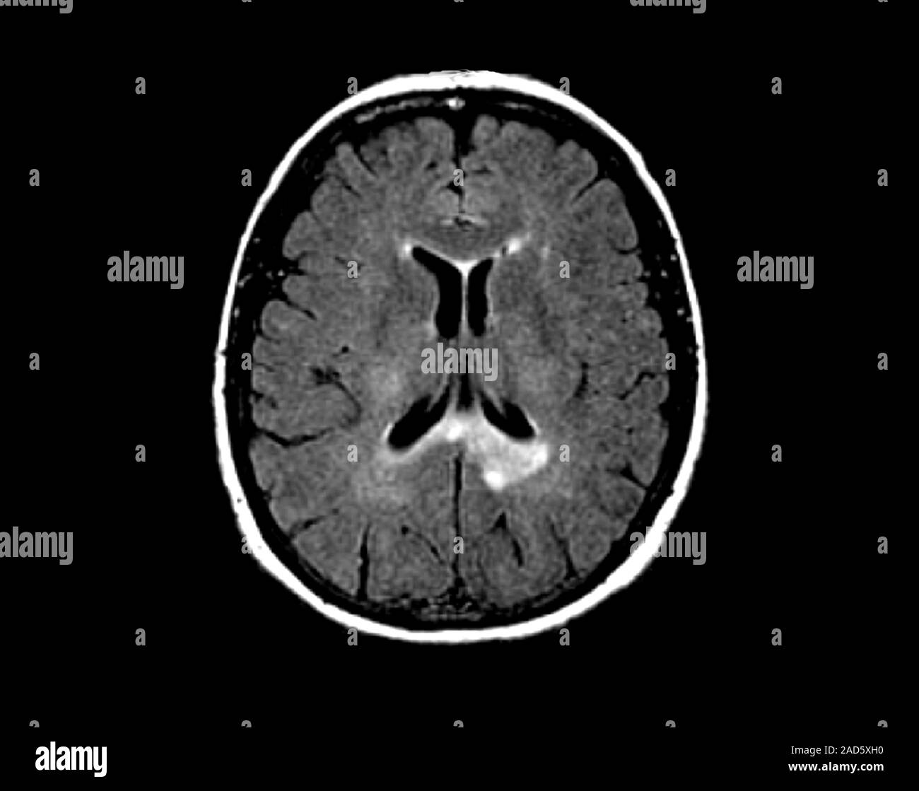 Multiple sclerosis. Axial magnetic resonance imaging (MRI) scan of the brain of a 42-year-old ...