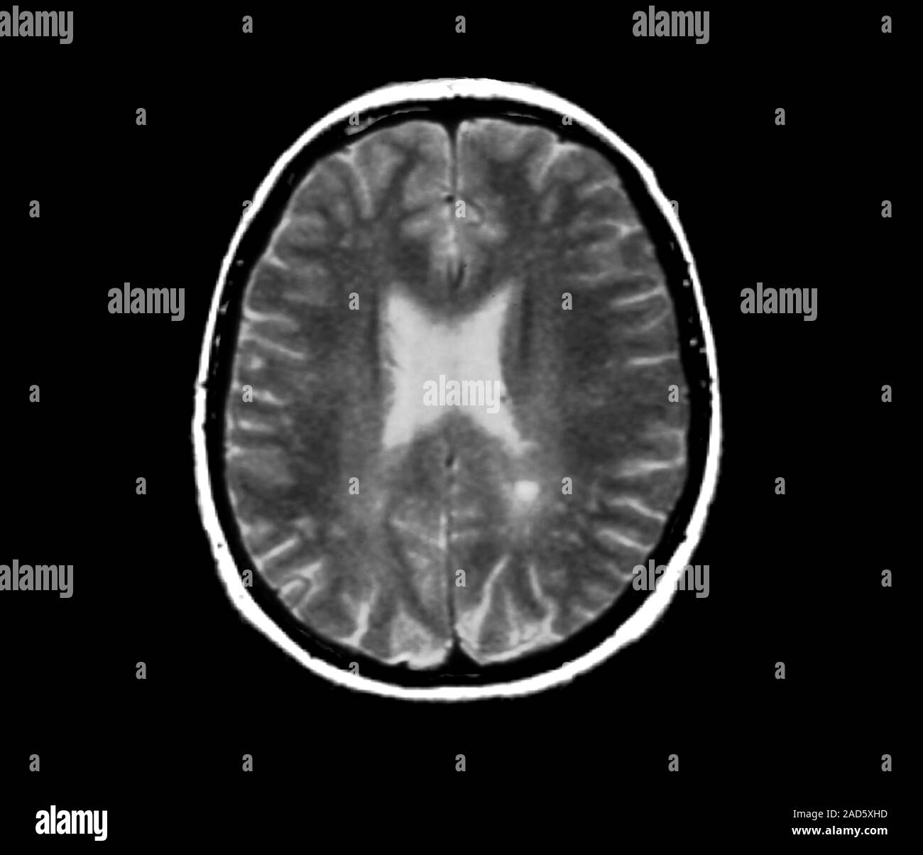 Lyme Encephalopathy Axial Magnetic Resonance Imaging Mri Scan Of The Brain Of A 41 Year Old