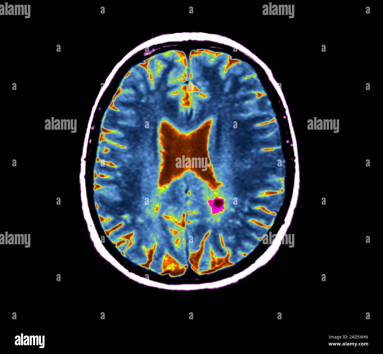 Lyme Encephalopathy Axial Magnetic Resonance Imaging Mri Scan Of The Brain Of A 41 Year Old
