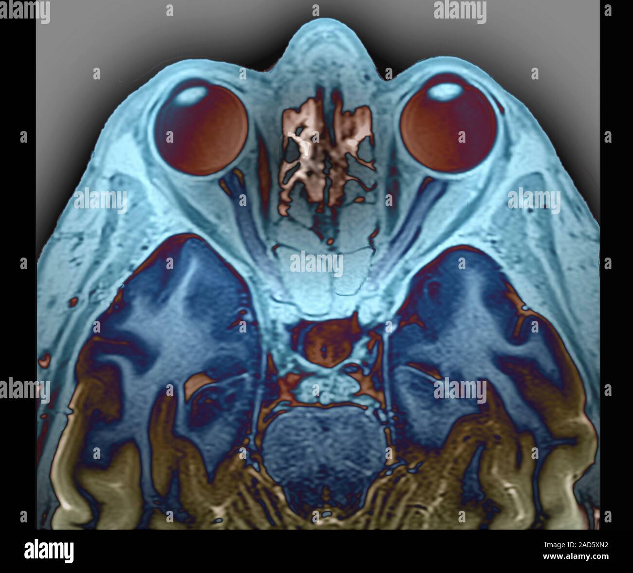 Human eyes and brain. Coloured axial magnetic resonance imaging (MRI ...