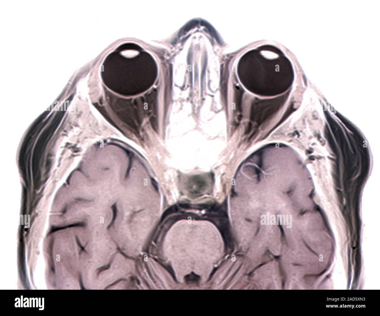 Optic nerve multiple sclerosis symptom. Coloured axial magnetic resonance imaging (MRI) scan of ...