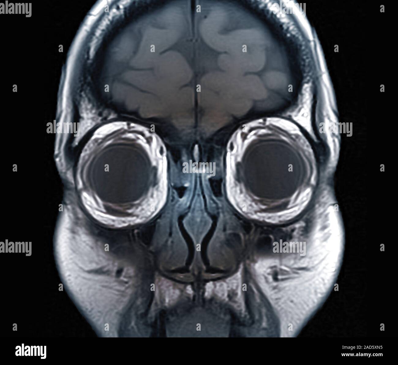 Eye anatomy and muscles. Coloured coronal magnetic resonance imaging ...