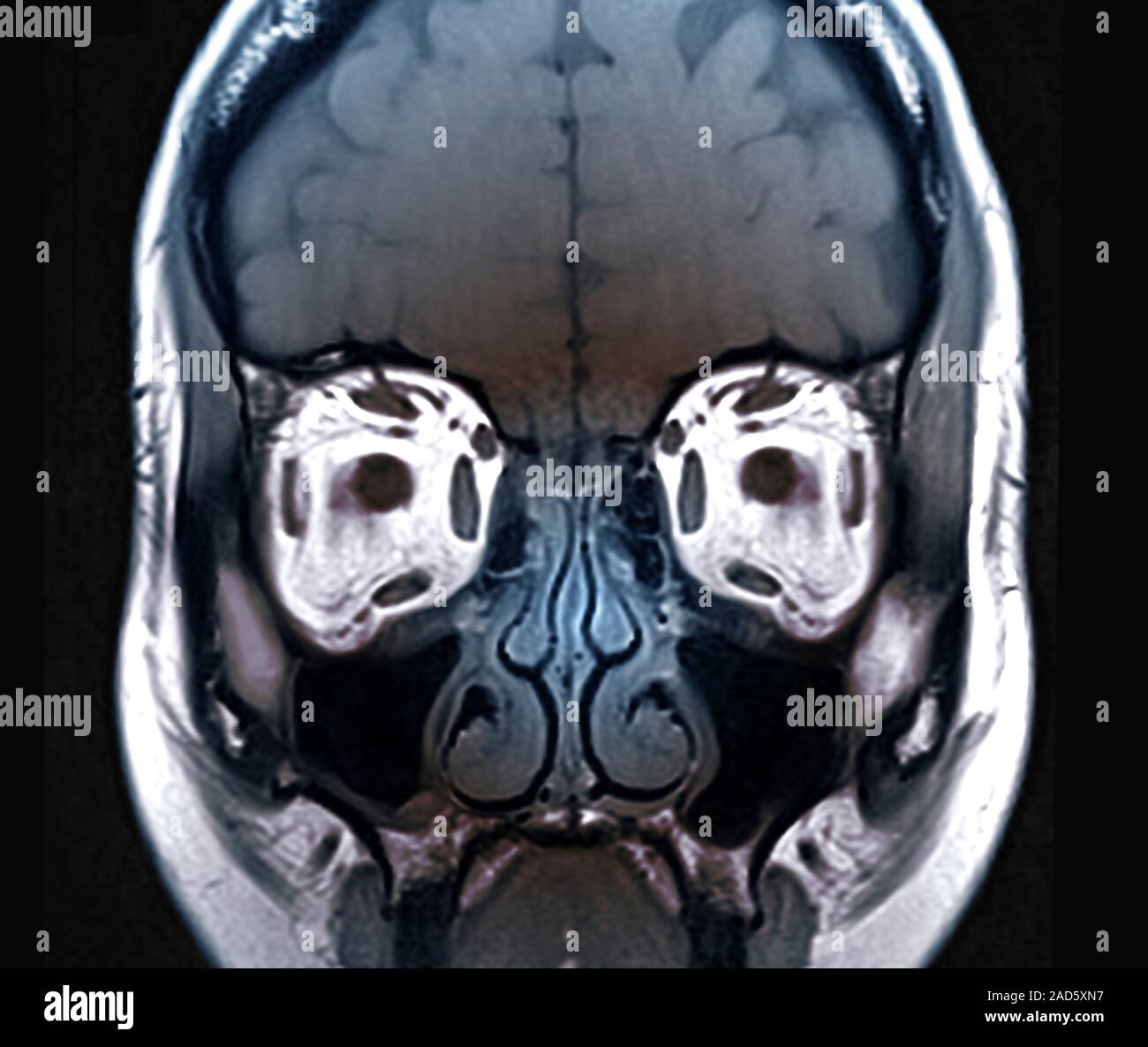 Eye anatomy and muscles. Coloured coronal magnetic resonance imaging ...