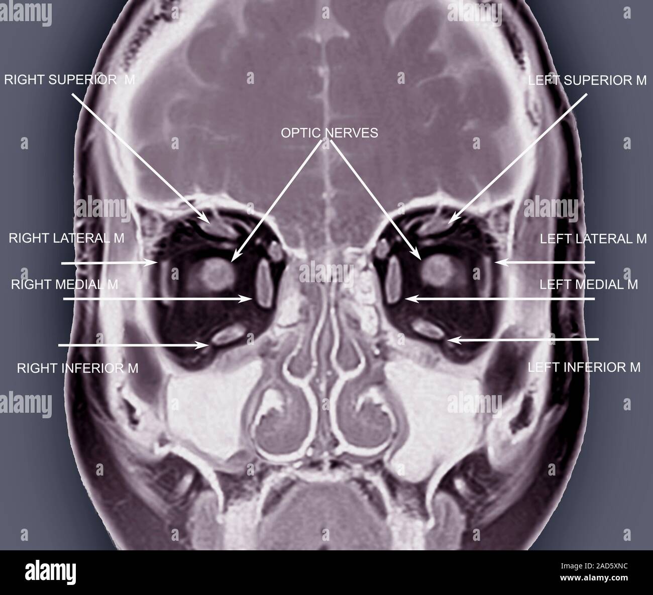Eye anatomy and muscles. Labelled coloured coronal magnetic resonance ...