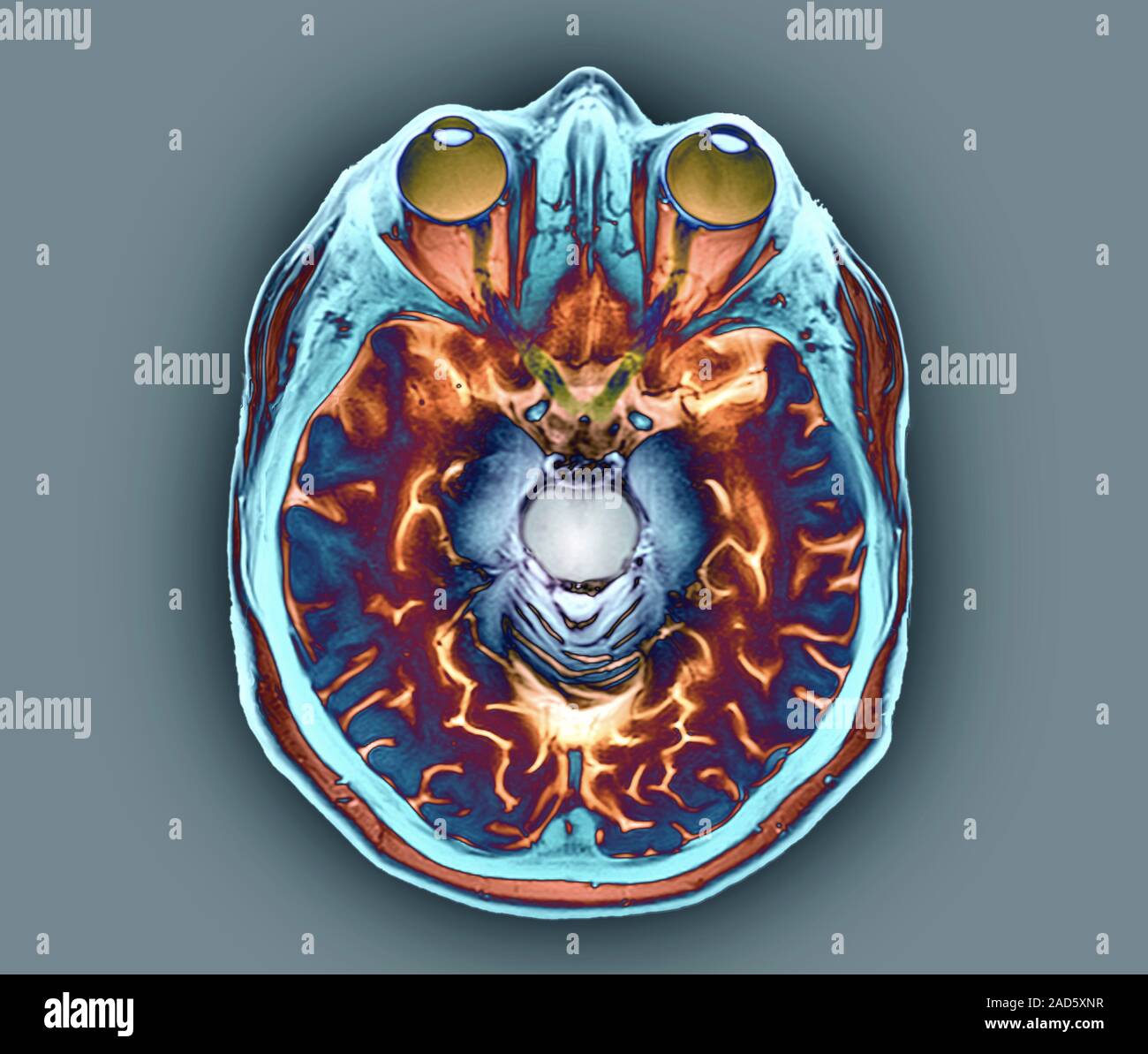 Human eyes and brain. Coloured axial magnetic resonance imaging (MRI ...