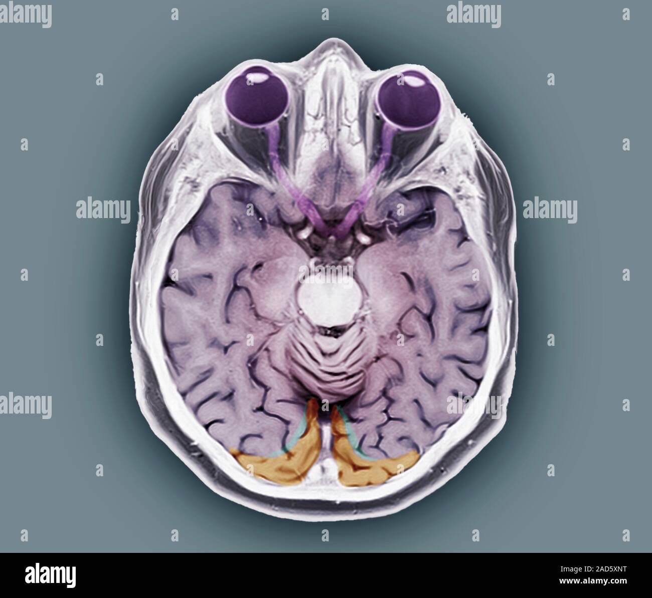 Human eyes and brain. Coloured axial magnetic resonance imaging (MRI ...