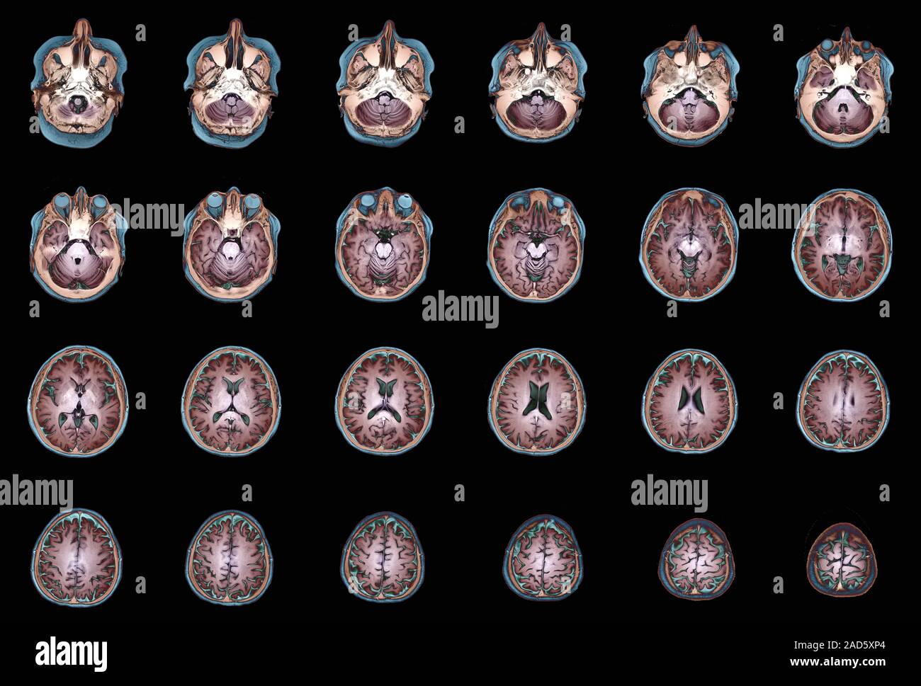 Human brain anatomy. Series of coloured axial magnetic resonance imaging (MRI) scans of the ...