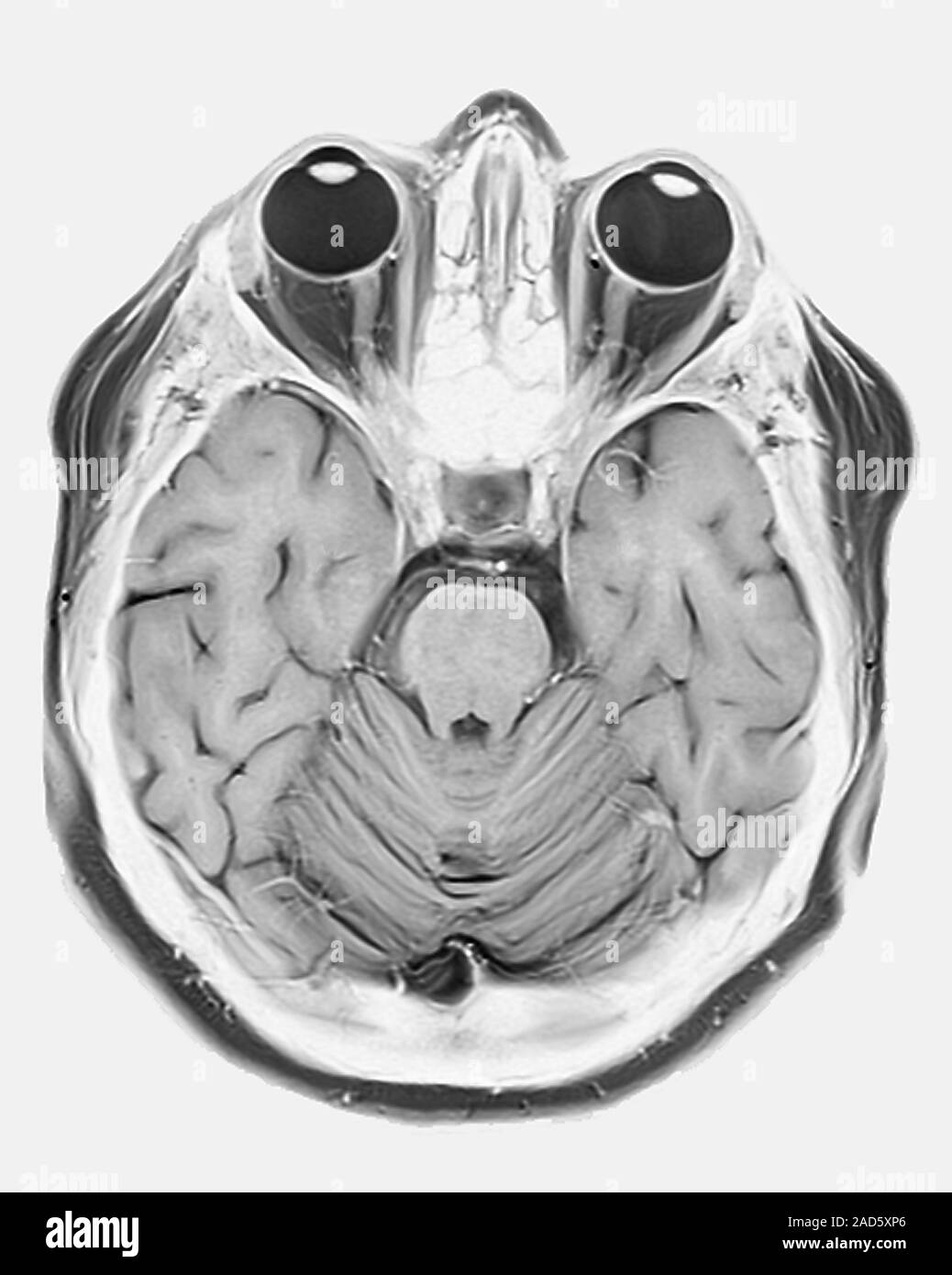Human eyes and brain. Axial magnetic resonance imaging (MRI) scan of ...