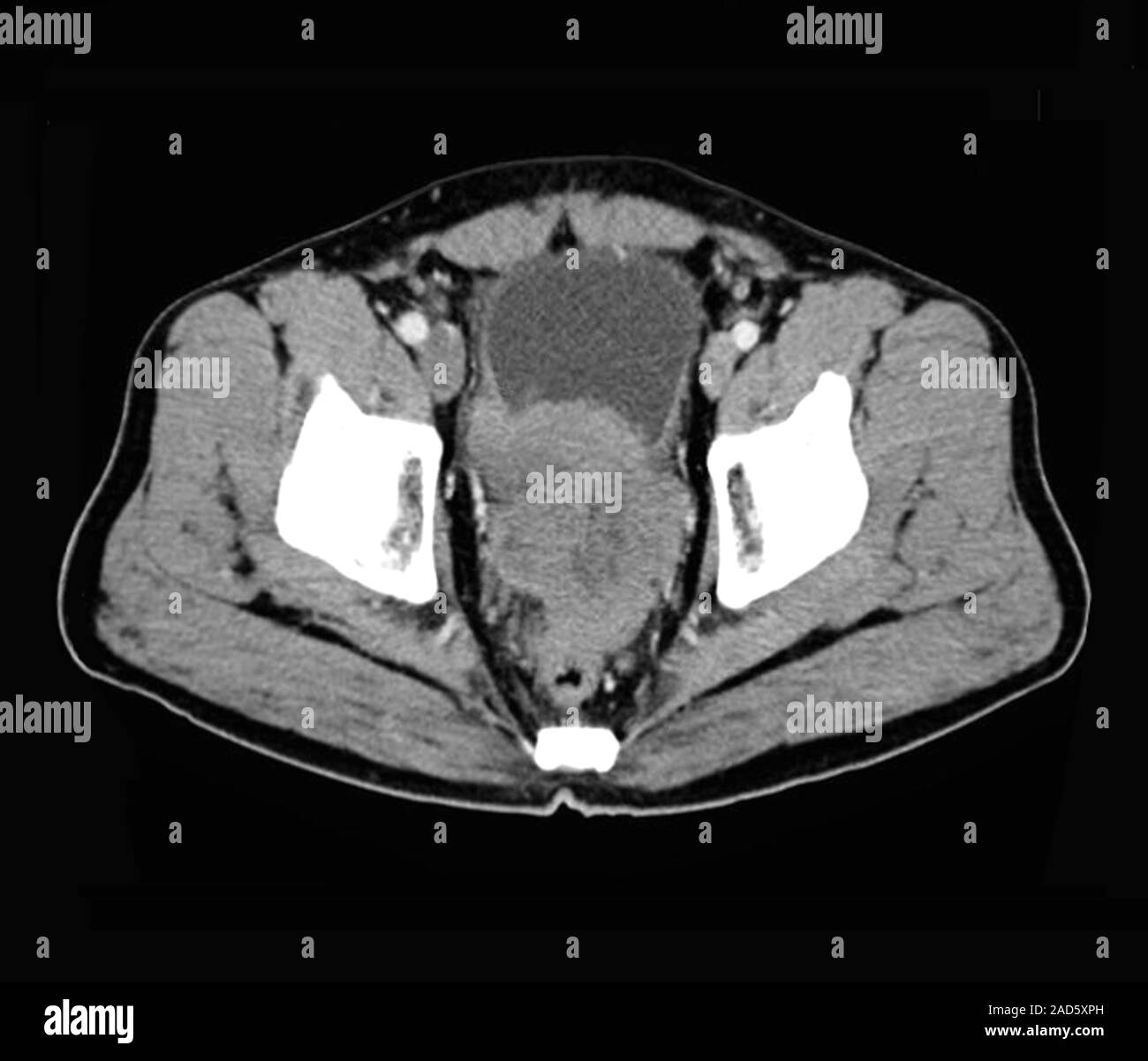 Prostate cancer. Axial computed tomography (CT) scan through the ...
