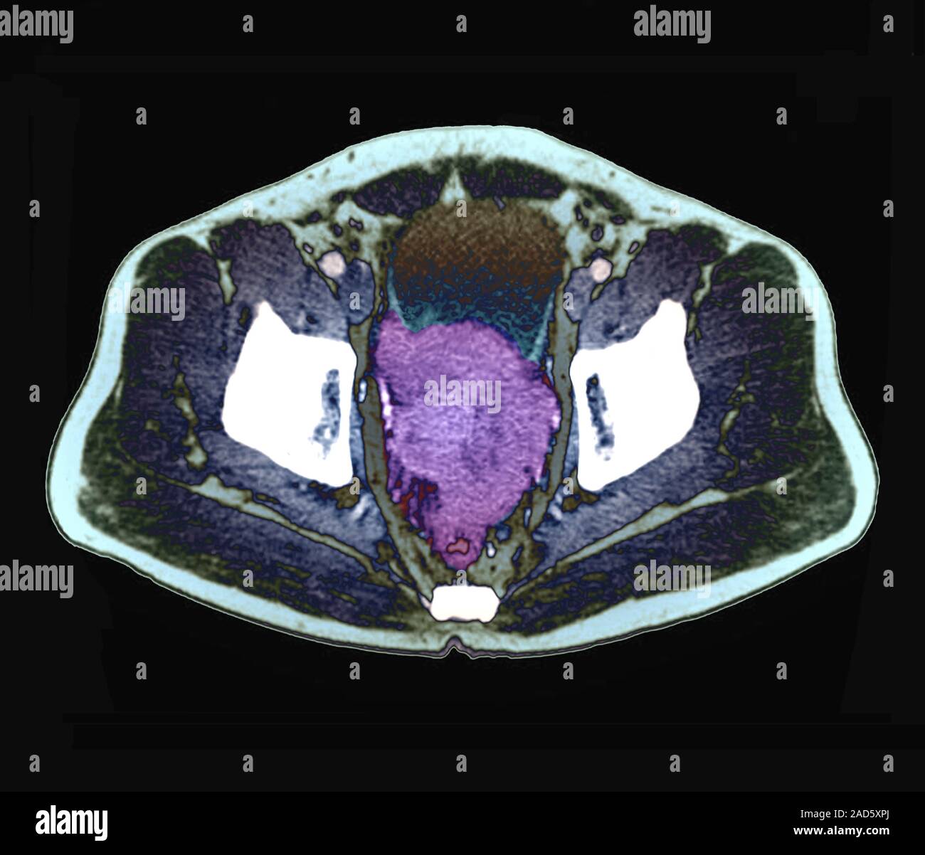 Prostate cancer. Coloured axial computed tomography (CT) scan through ...