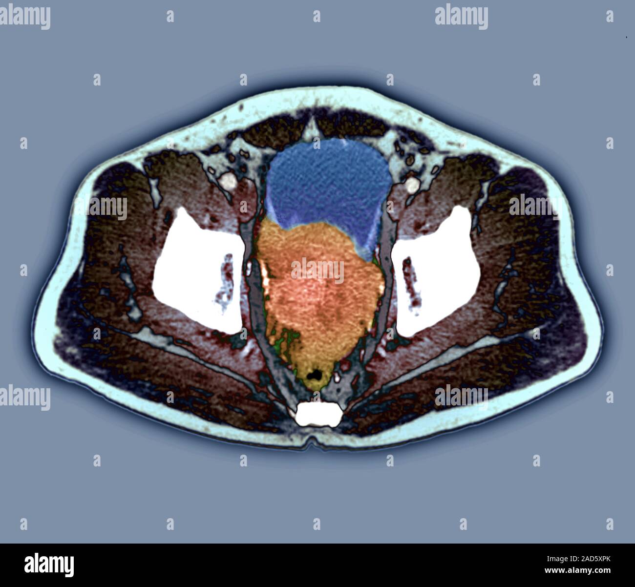 Prostate cancer. Coloured axial computed tomography (CT) scan through ...