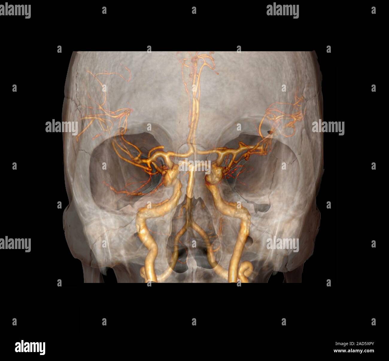 Brain arteries and Circle of Willis. Coloured 3D computed tomography (CT) scan and angiogram ...