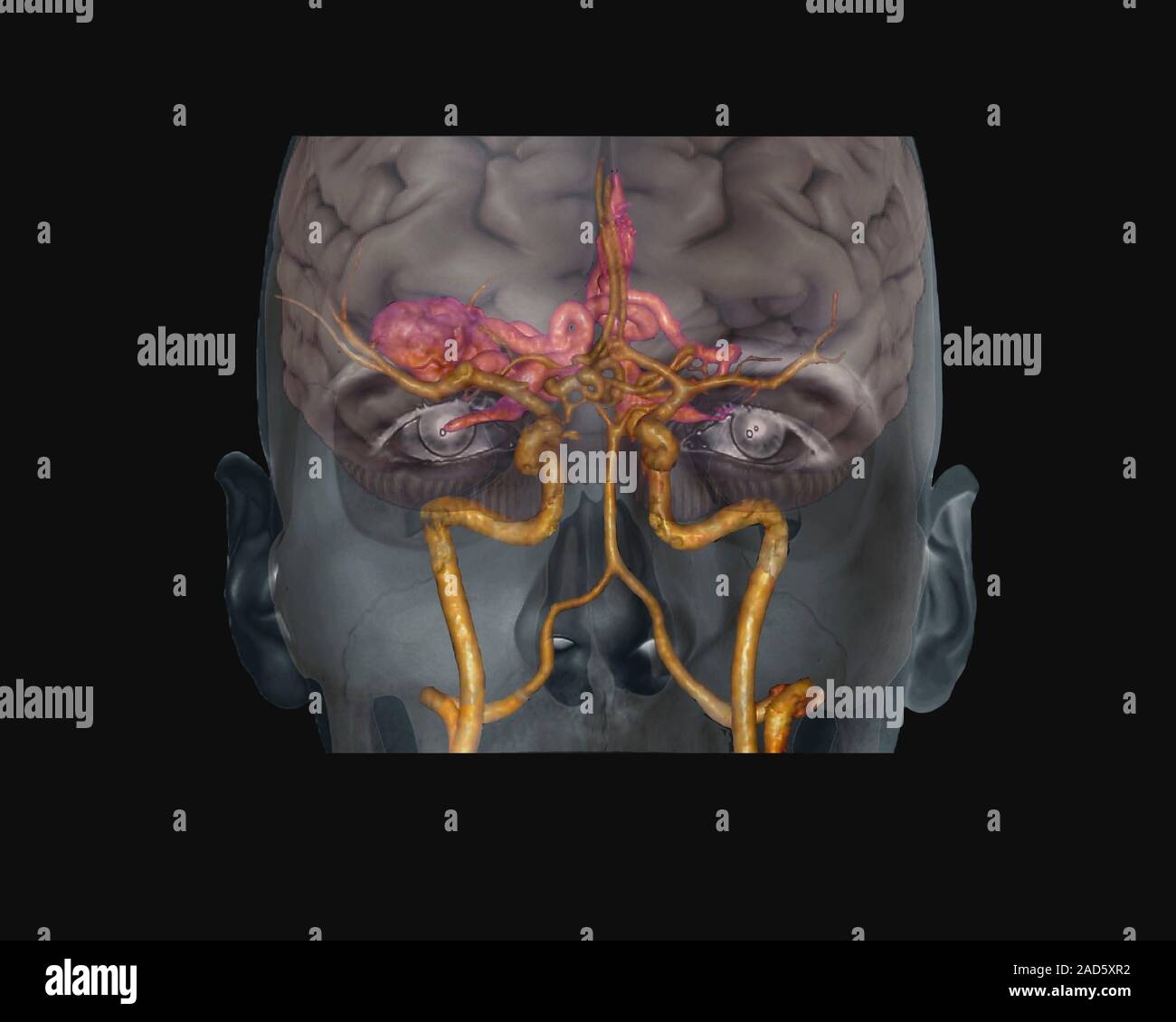 Cerebral arteriovenous malformation. Coloured 3D computed tomography (CT) scan and angiogram ...