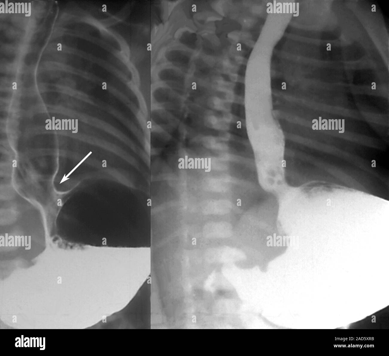 Oesophageal reflux. Frontal (left) and oblique (right) X-rays of the ...