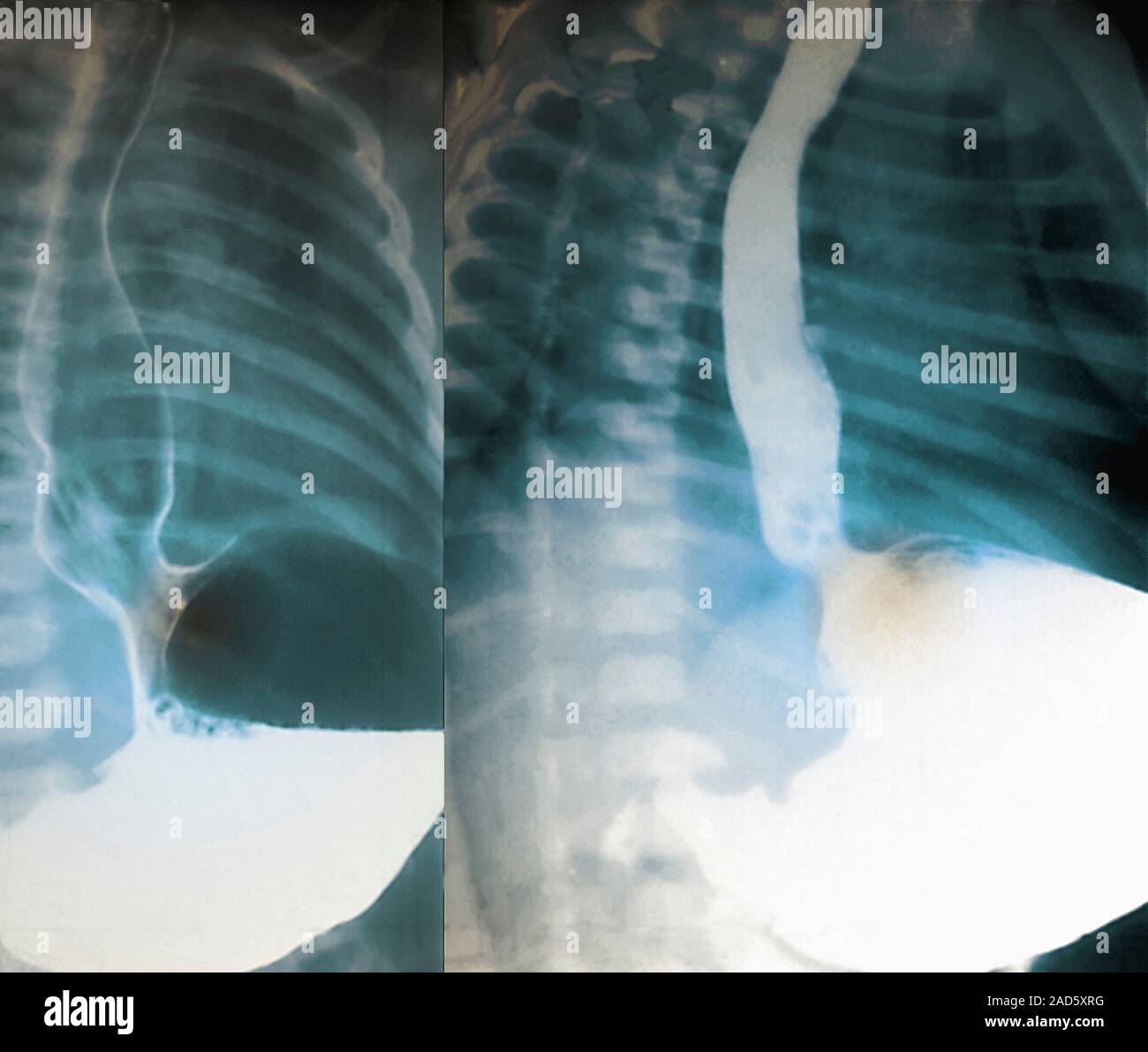Oesophageal reflux. Coloured frontal (left) and oblique (right) X-rays ...