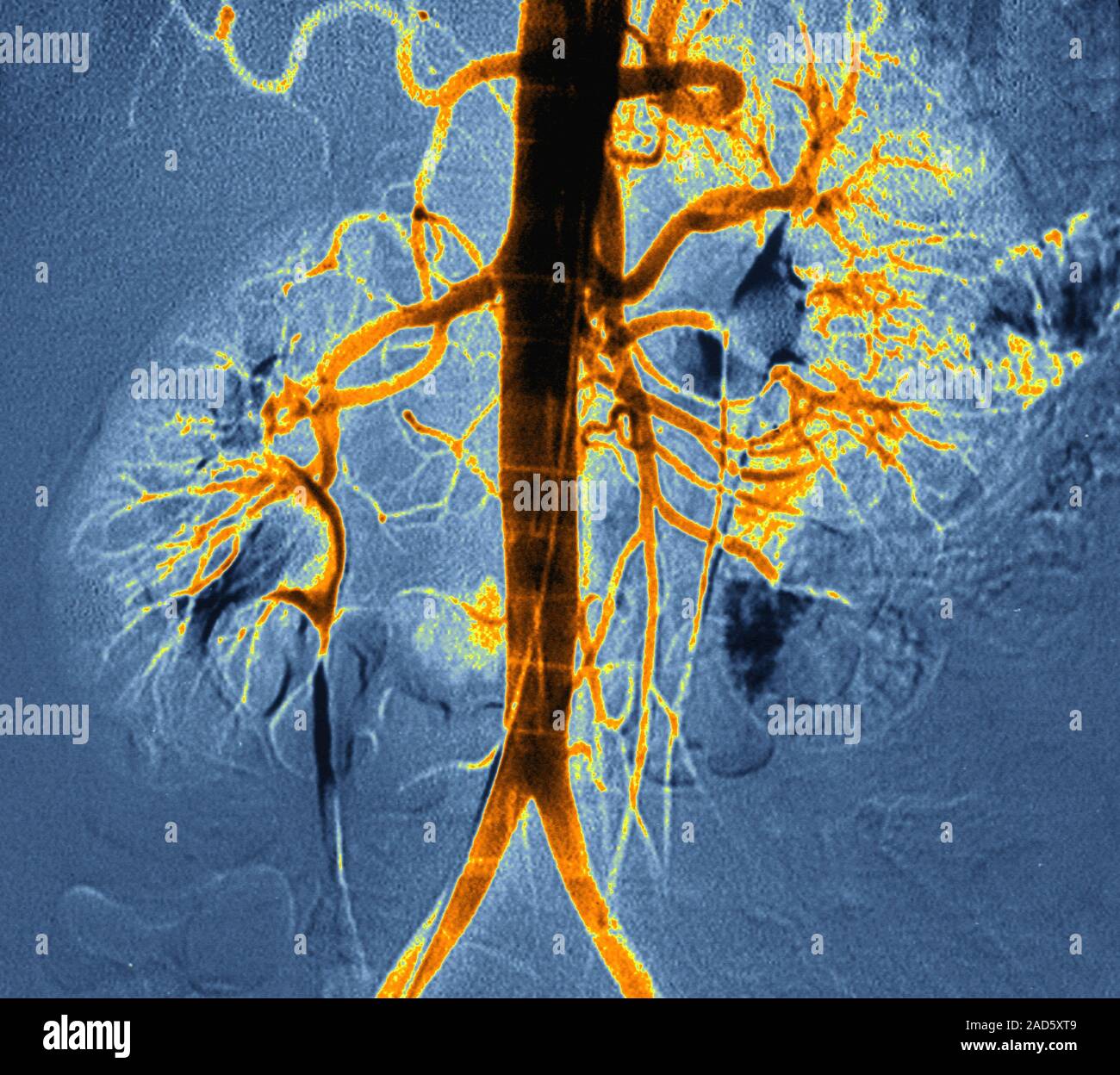 Kidney blood vessels. Coloured angiogram (blood vessel X-ray) of the ...