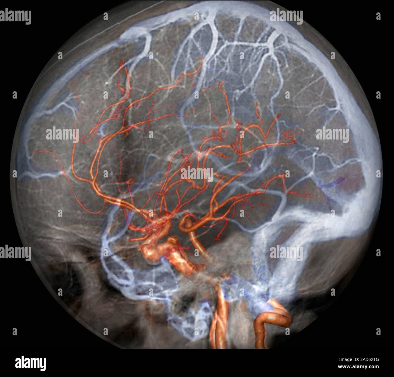 Brain blood vessels. Coloured 3D computed tomography (CT) scan and angiogram, highlighting the ...