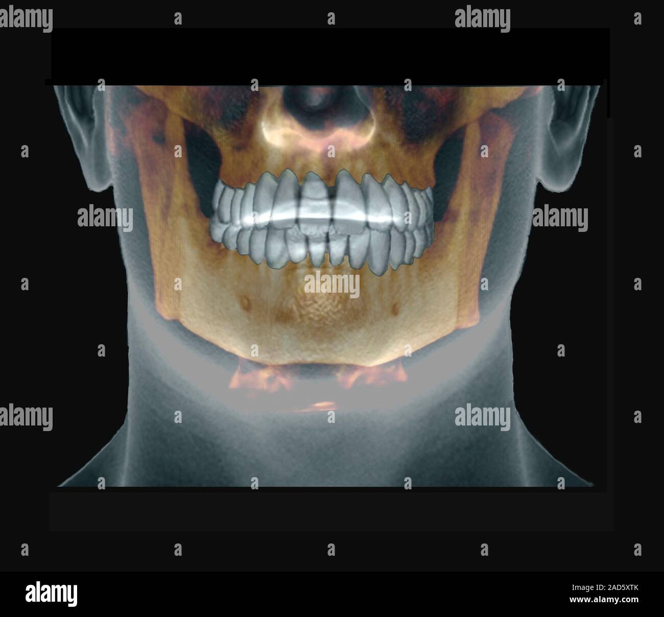 Adult teeth. 3D cone beam computed tomography (CBCT) scan of the normal ...