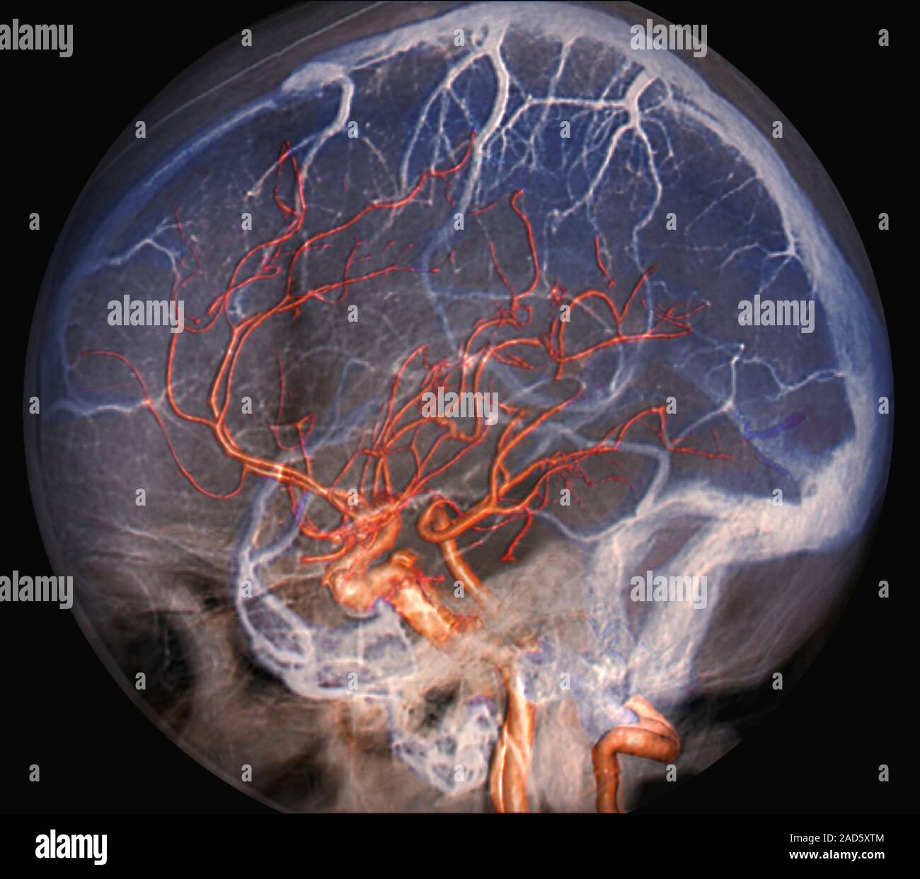 Brain blood vessels. Coloured 3D computed tomography (CT) scan and angiogram, highlighting the ...