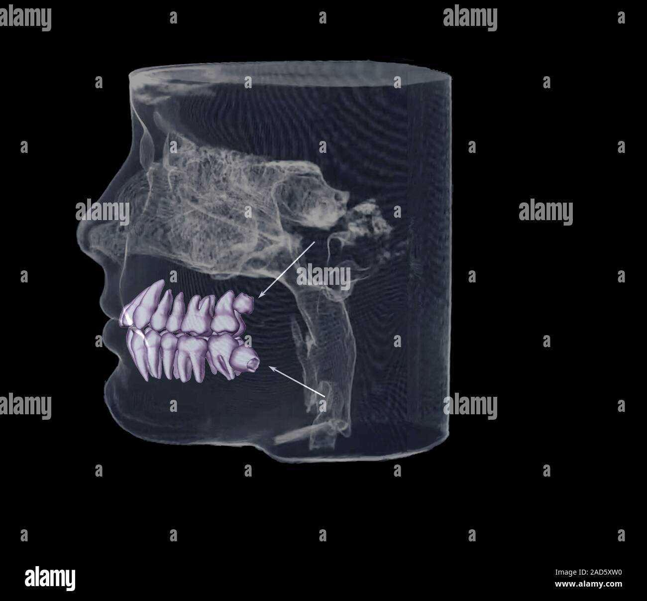 Inclined wisdom teeth. 3D cone beam computed tomography (CBCT) scan of ...