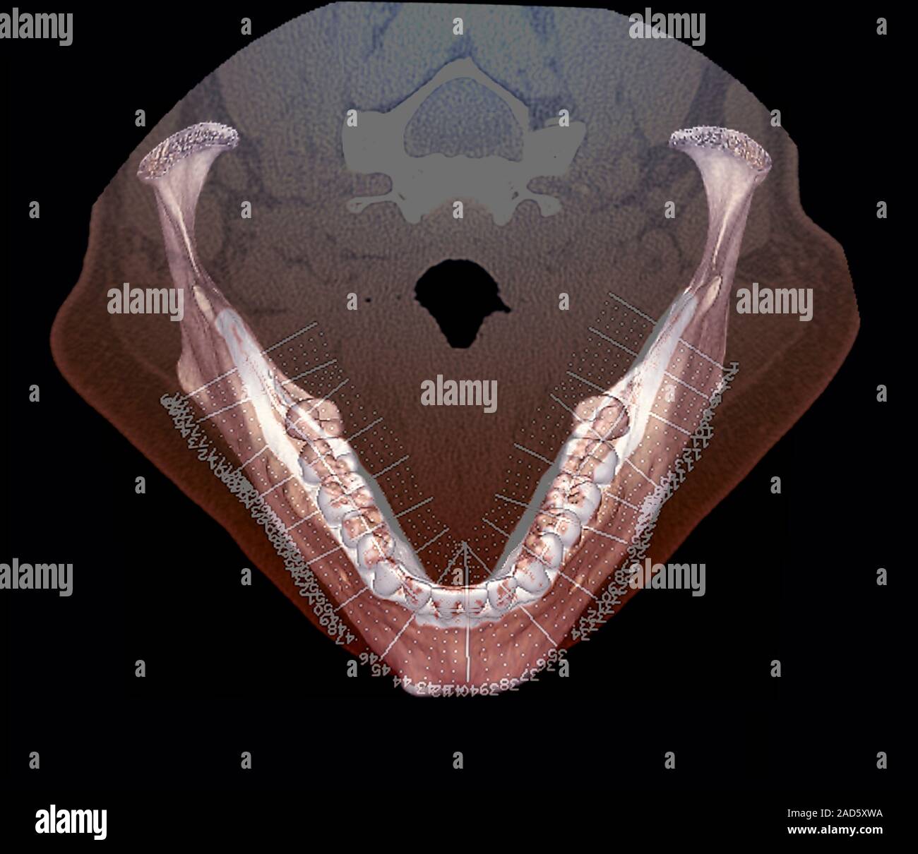 Lower jaw and teeth. 3D dental computed tomography (CT) scan of the ...