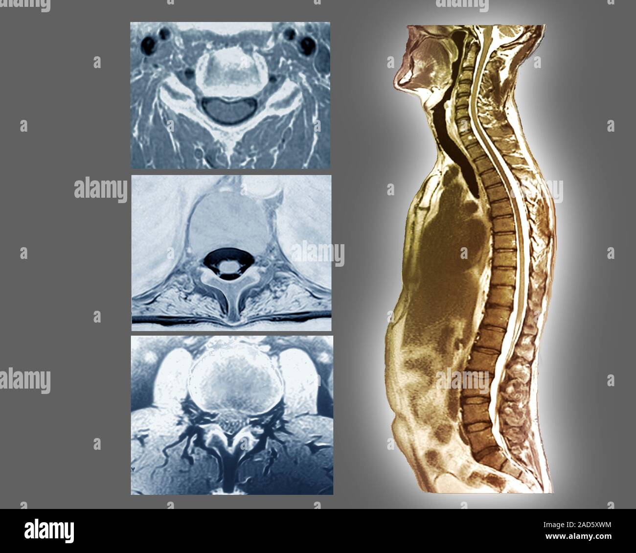 Backbone and spinal cord anatomy. Coloured magnetic resonance imaging ...